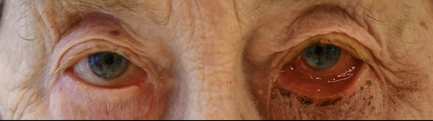 oculoplasty - New Eye Vision Center